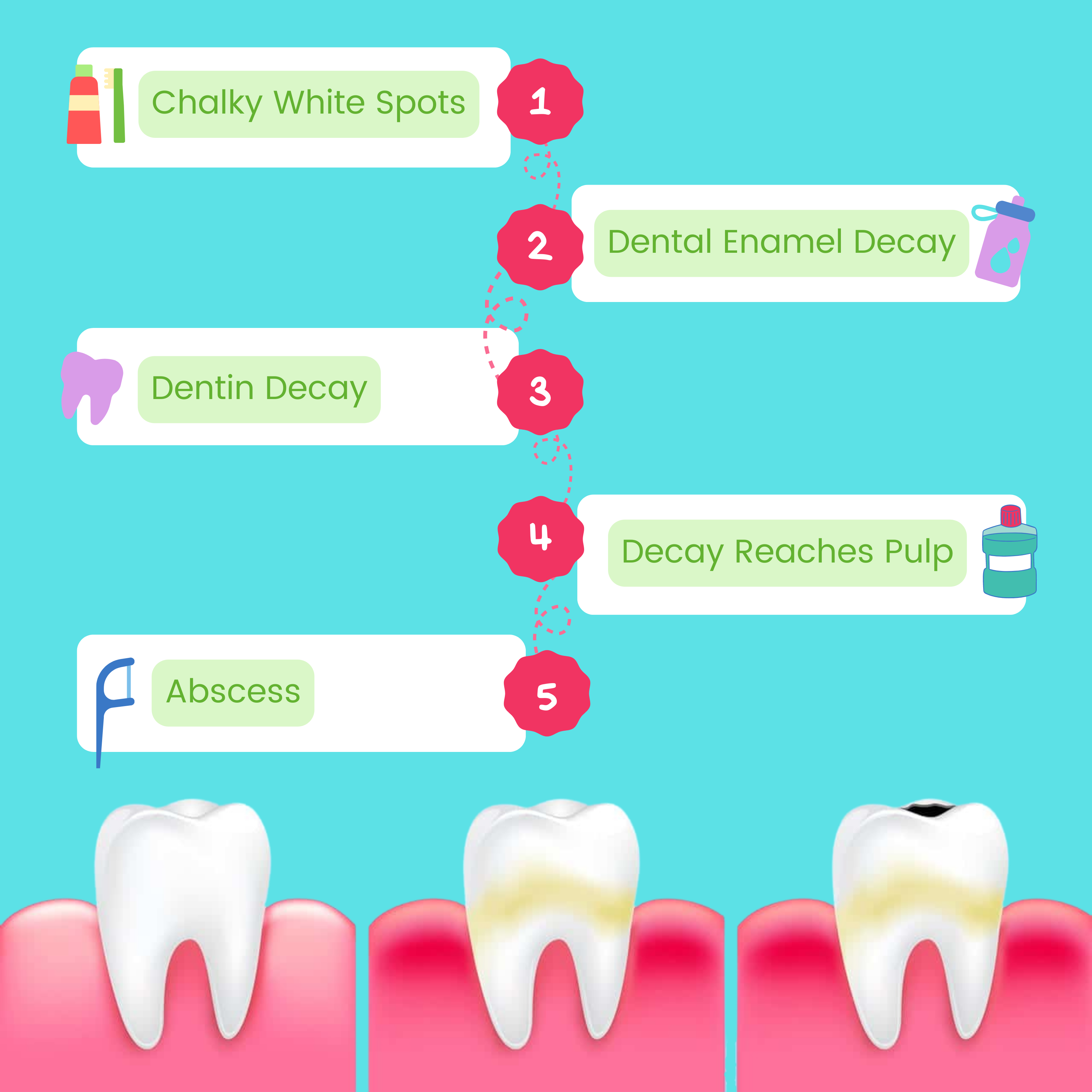 The Stages of Tooth Decay - Dental Care of Wichita